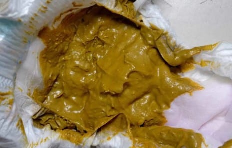 Selles couleur jaune causes et comment arrêter les selles jaunes